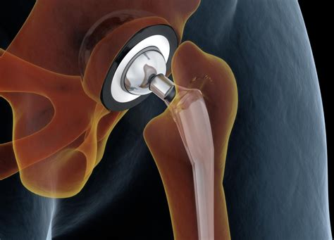 금속재질 엉덩이 관절 이식 환자 부작용 주의보 강화 네이버 블로그
