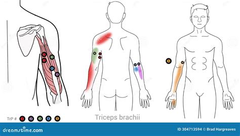 Triceps Brachii Managing Pain Arriving From Myofascial Trigger Points