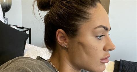 Womans Warning After Botched Thread Lift Left Her