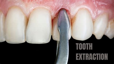 Understanding Tooth Extraction Everything You Need To Know