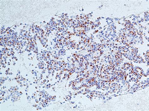 Pathology Outlines Neuroendocrine Neoplasms General