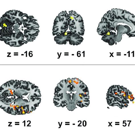 Spatial Brain Maps With Highlighted Brain Areas Whose Bold Signal