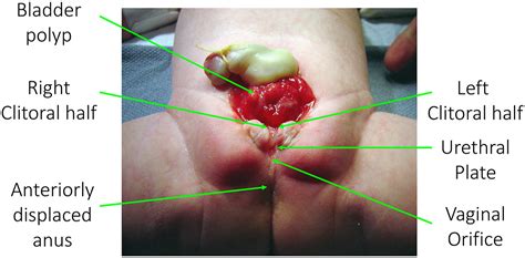 Exstrophy Epispadias Complex Urologic Clinics