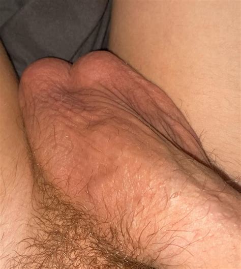 Is This Varicocele R Varicocele