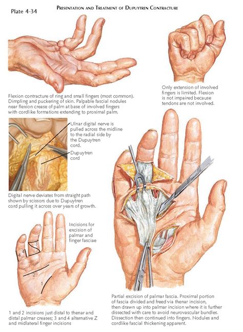 Dupuytren Contracture Pediagenosis