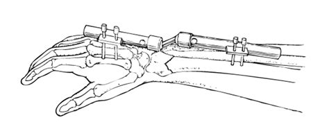 Image External Fixator Msd Manual Consumer Version
