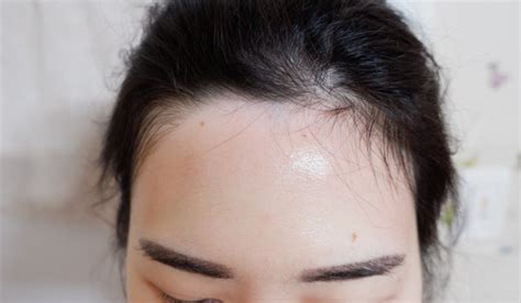 3자이마 레이저제모 후기~ 헤어라인교정 도전 Feat 내돈 네이버 블로그