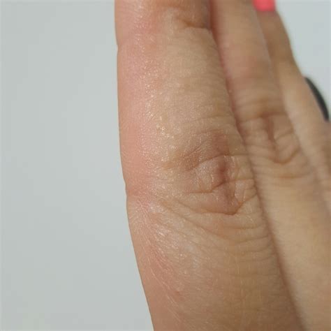 손가락 수포 좁쌀만한 물집 한포진 네이버 블로그