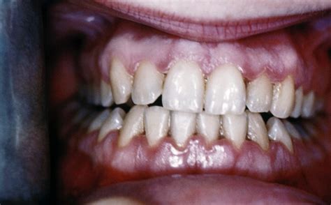 What Exactly Is Gum Disease