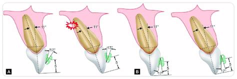 A And B A Positive Torqued Bracket Can Cause Impingement Of Root Download Scientific Diagram