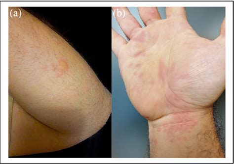Figure 1 From Normocomplementemic Urticarial Vasculitis Secondary To Lyme Disease A Rare