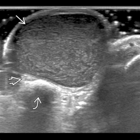 Dermatofibrosarcoma Protuberans Radiology Key