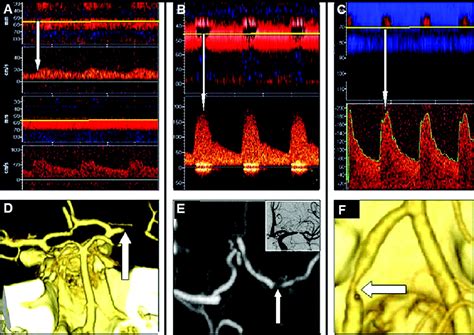 Validation Of Transcranial Doppler With Computed Tomography Angiography