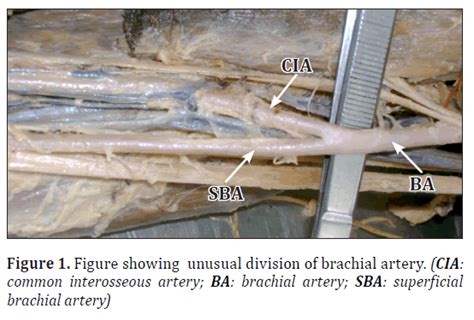 Bilateral Superficial Brachial Artery And High Origin Of Common