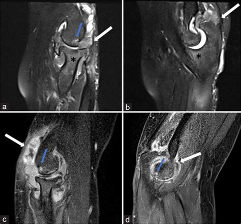Magnetic Resonance Imaging In Arthropathies Of Elbow Joint A Pictorial Review Indian Journal