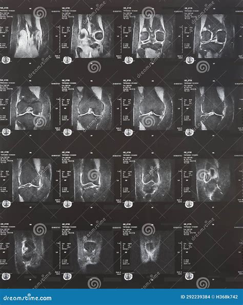 Gorra De Rodilla Patela Resonancia Magnética Osteoartritis Anatomía