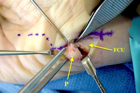 Pisiform Fractures Hand Surgery Resource