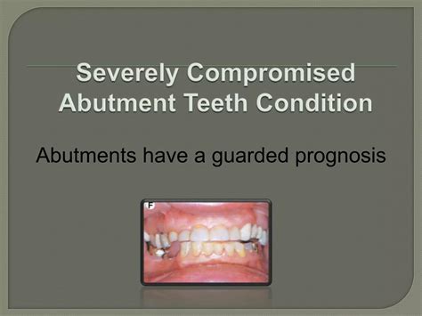 Classification Of Rpd Pptx