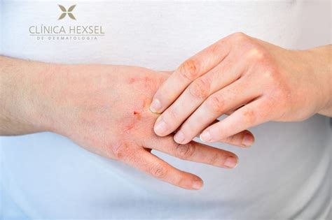 O que é dermatite atópica Clínica Hexsel