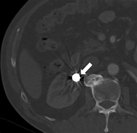 Coil Embolization Of Renal Artery Pseudoaneurysm At Erin Ayers Blog