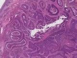 Squamous Cell Carcinoma Histopathology Cervix Video MEDtube Net