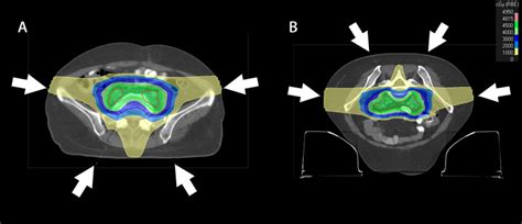 Dosimetric Evaluation Of Bone Marrow Sparing In Proton Radiotherapy For Cervical Cancer Guided