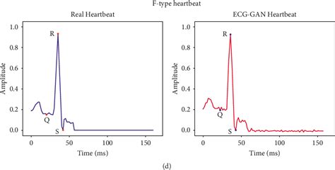 Figure 12 From Deep Learning Based Data Augmentation And Model Fusion For Automatic Arrhythmia
