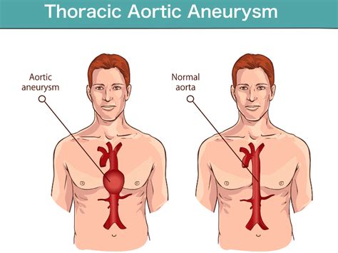 Aortic Aneurysm Facts Types And Risk Factor Wisdom Imbibe