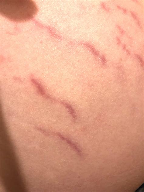 What Could These Red Lines On My Skin Be Been Over A Month And Hasnt Faded I Noticed It Right