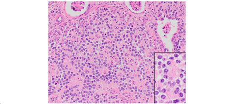 Rosette Or Tubule Like Formations Hande × 200 Inset Hande × 400