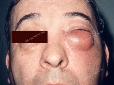 Orbital Cellulitis