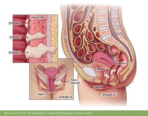Vaginal Cancer Stages Md Anderson Cancer Center