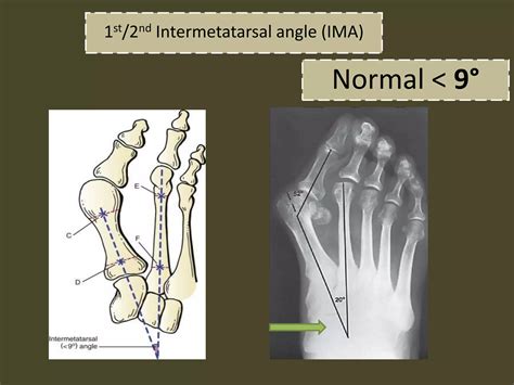Hallux Valgus And Hallux Rigidus Pptx