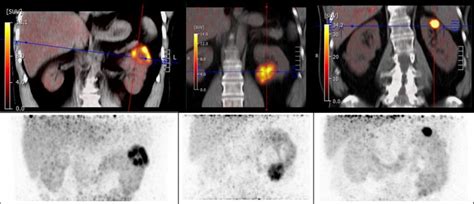 Renal Cell Carcinoma New Radiotracer Improves Detection And