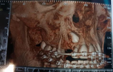 Ectopic Tooth In Nose Rpopping