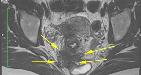 Huge Endometriosis Nodule Of Parameter Rectum Vagina Bladder And S3