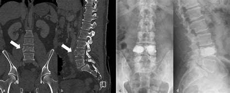 A Lumbar Compression Fracture At L4 Treated With A Vertebral Body Stent Download Scientific