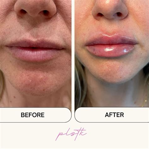 Russian Lip Filler Everything You Need To Know Artofit