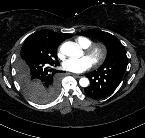 Axial Contrast Enhanced Ct Of The Chest 2 Mm Slice Thickness 100 Ml Axial Contrast Enhanced Ct Of The Chest 2 Mm Slice Thickness 100 Ml