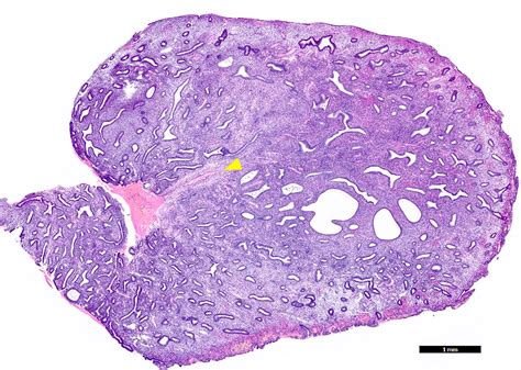 Fibroepithelial Polyp Histology