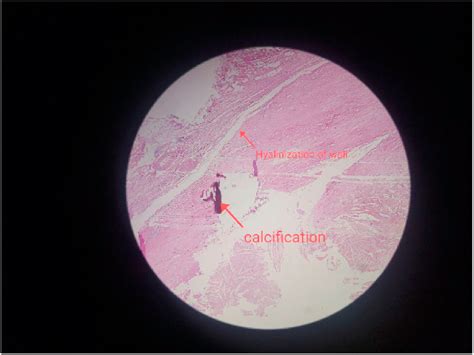Histopathological Picture Showing Calcification Of The Gall Bladder