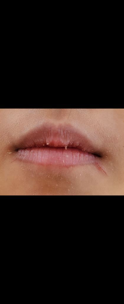 아이 흉터가 걱정되요 연고를 바르고 있는데 피부과에 가봐야할까요 ㅣ 궁금할 땐 아하