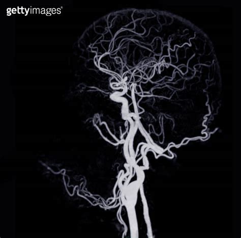 Ct Angiography Of The Brain Or Cta Brain Showing Cerebral Aryery 1491186012 게티이미지뱅크
