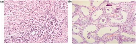 A B Pathological Diagrams Of Granulomatous Orchitis Hematoxylin And