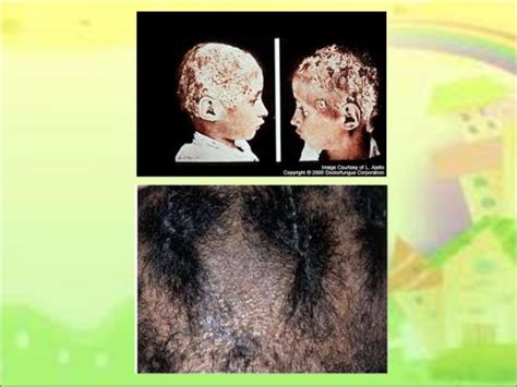 Tinea Favosa