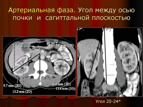 Селективная почечная ангиография Артериальная фаза Online Presentation