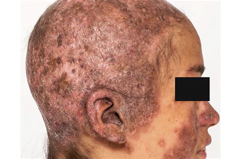 Extensive Scarring Alopecia And Widespread Rash Mdedge