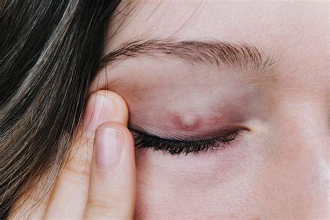 Eyelid Pimple Inside