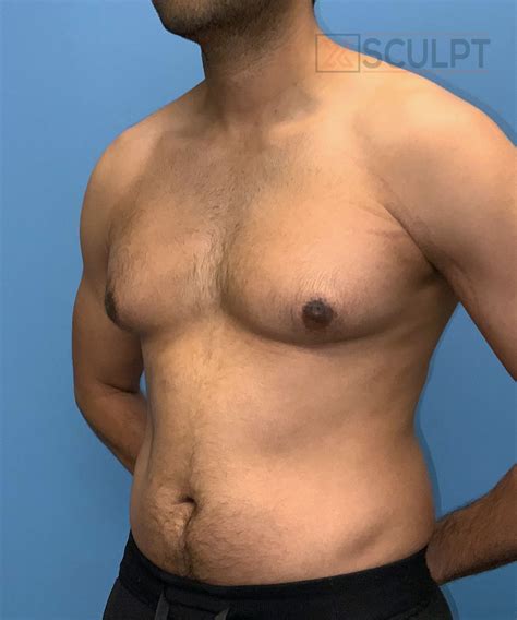 Grade 2 Gynecomastia Gallery 608 Xsculpt™