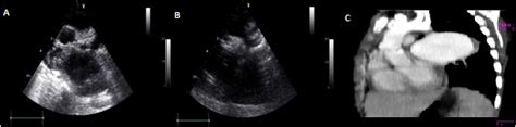 Scielo Brasil Infectious Endarteritis In Aortic Coarctation Two
